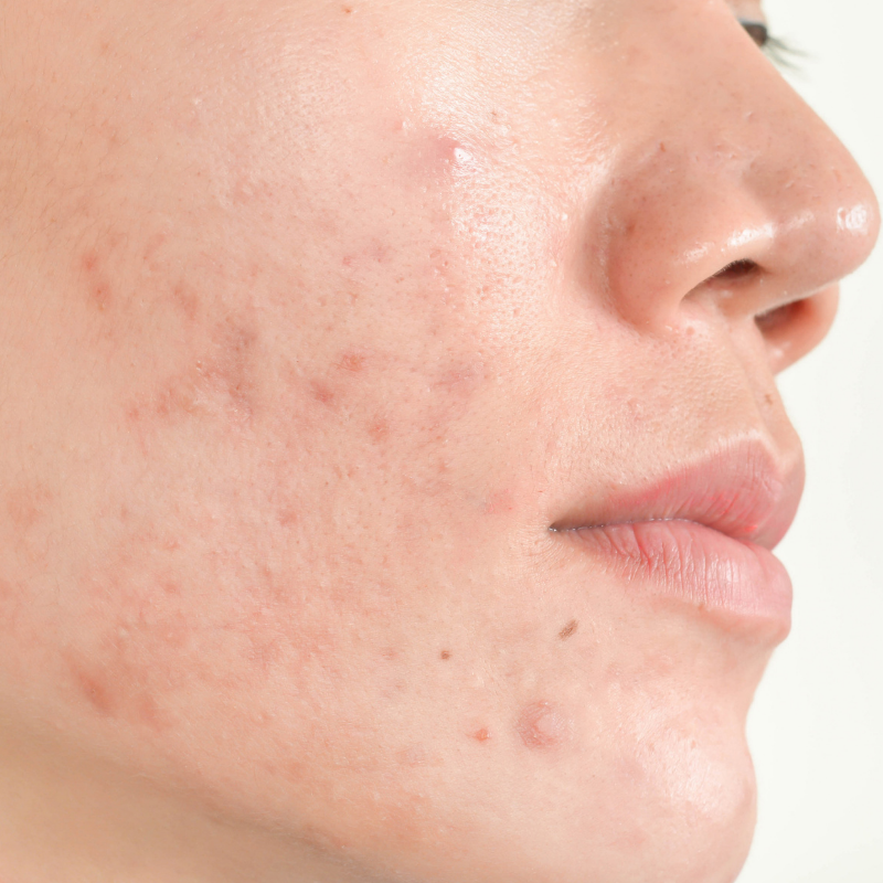 Acne Dark Spots On Face